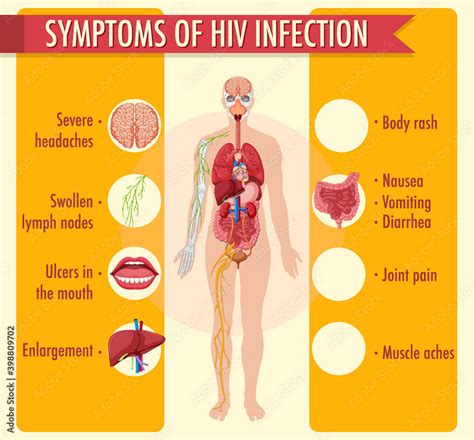 Symptoms Of Hiv Infection Infographic Stock Illustration Adobe Stock