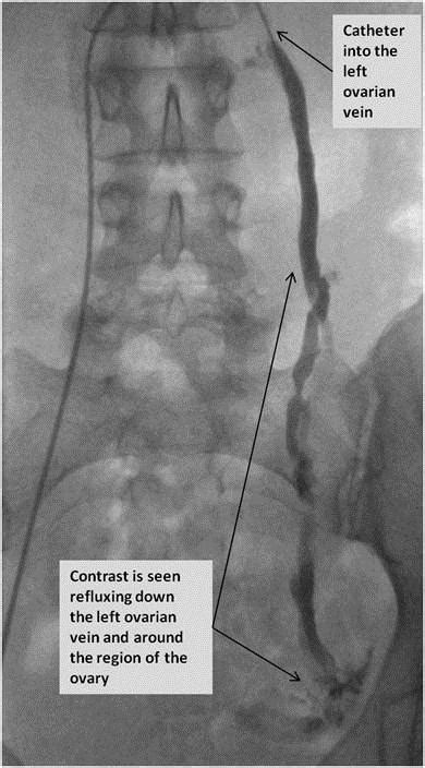 Pelvic Venous Congestion Syndrome Bsir