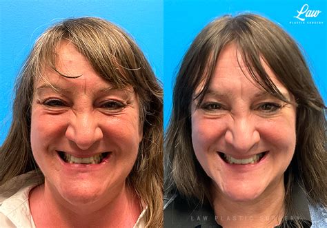 Scar Revision Before And After Photos Sage Plastic Surgery