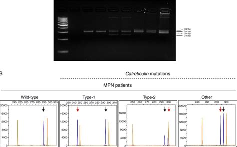 Calreticulin Calr Indel Mutations In Myeloproliferative Neoplasm