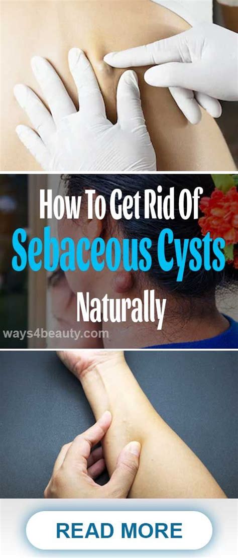 How To Get Rid Of Sebaceous Cysts Naturally Ways For Beauty How To