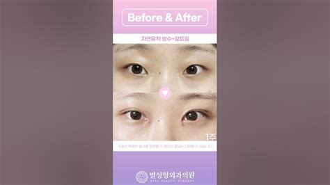자연유착💕💕 쌍수후기 쌍수 인라인쌍수 쌍수잘하는곳 쌍수잘하는병원 쌍수부작용 쌍수유명한곳 쌍수유명한병원 Youtube