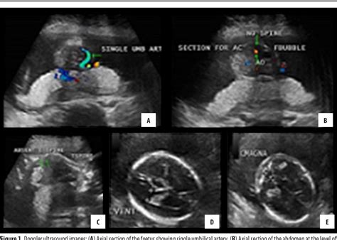 Figure 1 From A Rare Case Of Caudal Regression Syndrome In A Foetus Of