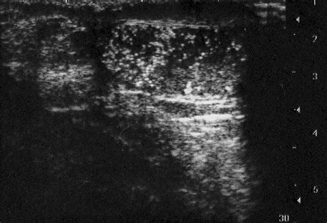 Figure Ultrasonographic Image Of The Testicle Demonstrated Grade 3