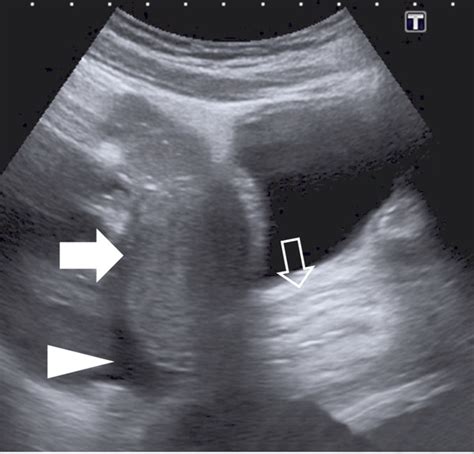 15 Sonography Of The Female Genital Tract Radiology Key