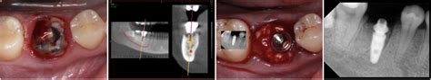 Immediate Implant Placement In Molar Extractions Sockets Using A