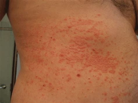B6 Deficiency Rash