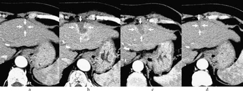 Findings Of Multidetector Row Computed Tomography Of Hccs Treated By