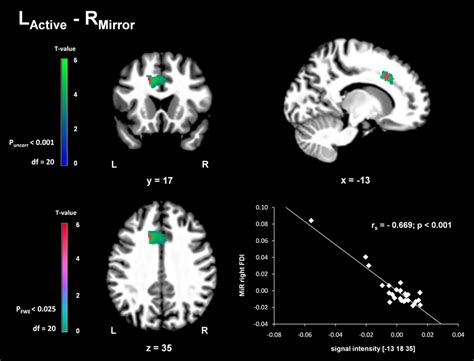 Negative Correlation Between Gmv In Left Acc And Mirror Recruitment Of