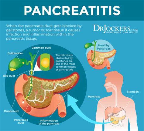Pancreatitis Size Chatroom Sales Of Photos