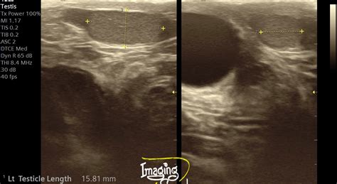 Case 82 Encysted Hydrocele Of The Spermatic Cord