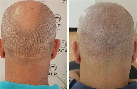 The Ultimate Guide To The Average Hair Transplant Costs Around The