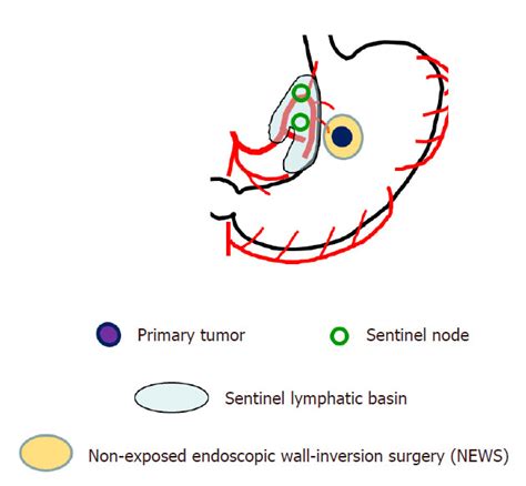 Laparoscopic Personalized Function Preserving Gastrectomy With Sentinel