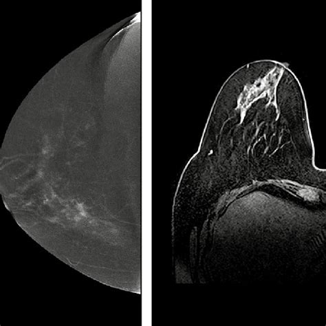 From The Left Low Energy Contrast Enhanced Spectral Mammography