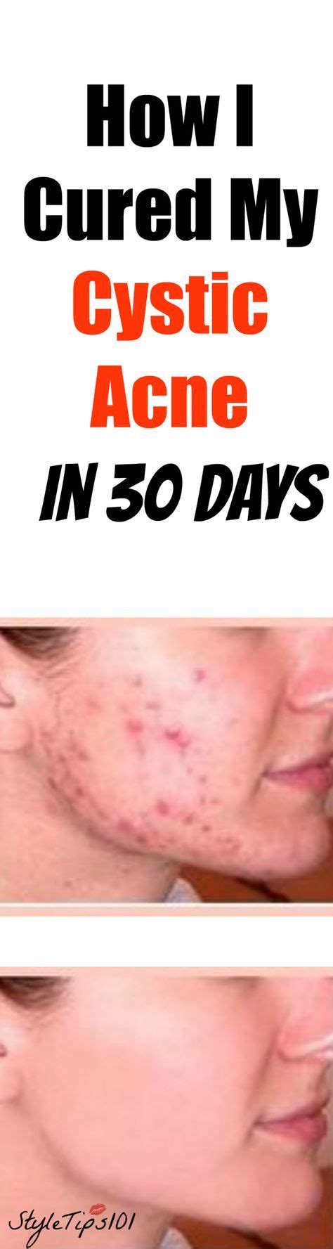 How I Cured My Cystic Acne In 30 Days Cystic Acne Treatment Cystic
