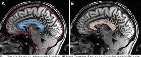 Figure 1 From The Impact Of Multiple Sclerosis On The Size And