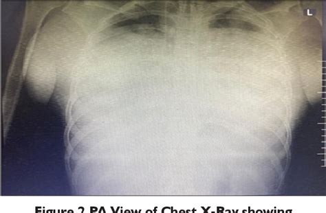 Figure 2 From A Rare Case Of Pulmonary Thromboembolism And Acute