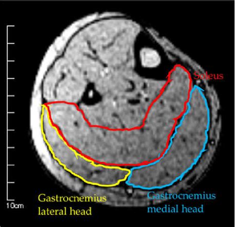 Measurement Of Muscle Cross Sectional Area By Mri Download