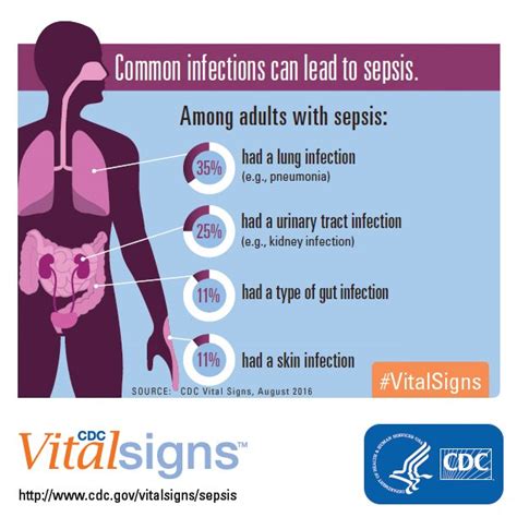 Five Key Facts To Know About Sepsis Thedacare