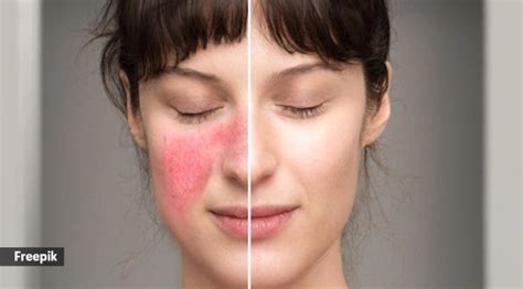 Does Chamomile Green Tea Work For Facial Redness Life Style News
