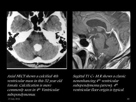 Radiological Features Of Intracranial Tumors 2