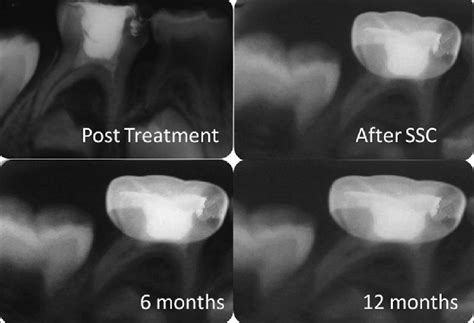 Follow Up Radiographs After Diode Laser And Mta Pulpotomy Download