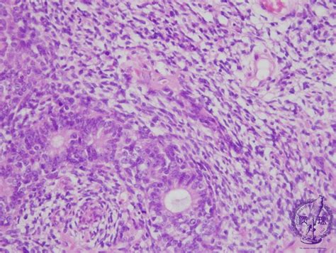 18 Soft Tissue 8 Synovial Sarcoma Pathology Core Pictures