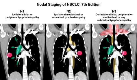 Mediastinal Lymph Node Staging From Noninvasive To Surgical Ajr