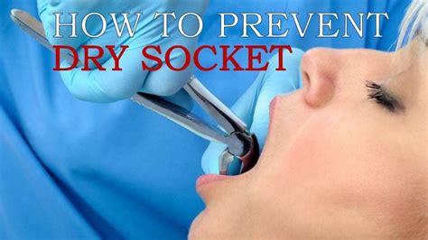 How To Prevent Dry Socket