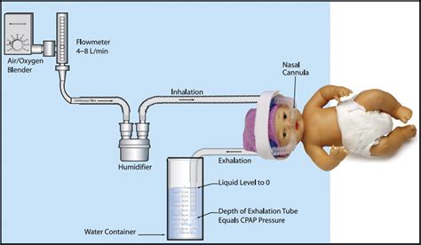 Continuous Positive Airway Pressure Clinics In Perinatology