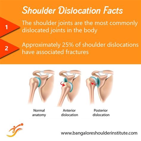 Posterior Shoulder Dislocation Symptoms Treatment