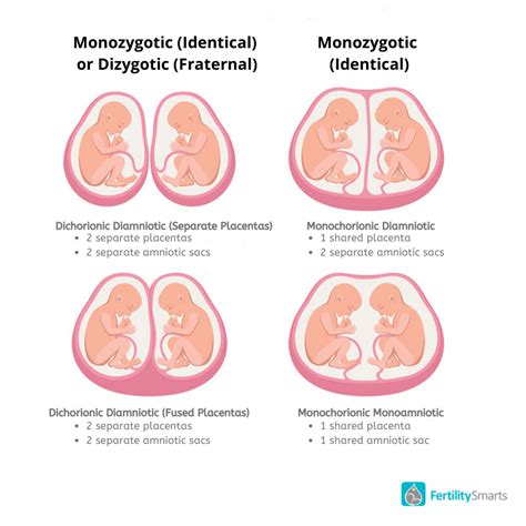 What Are Monochorionic Diamniotic Twins Definition From