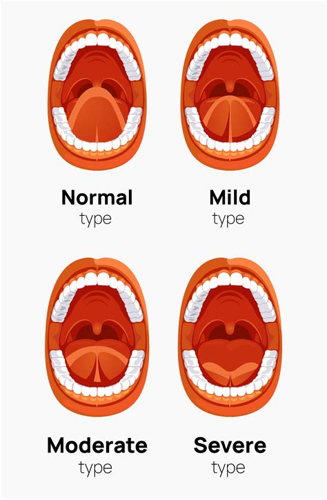 Tongue Tie In Adults Treatment Options Healthnews