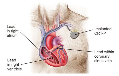 How Crt P And Crt D Devices Work Boston Scientific