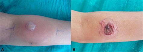 Cutaneous Tuberculosis Part I Pathogenesis Classification And