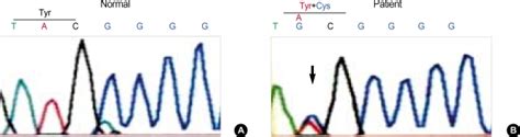 Electropherograms Of Dna Sequencing For Y161c Mutation A Normal