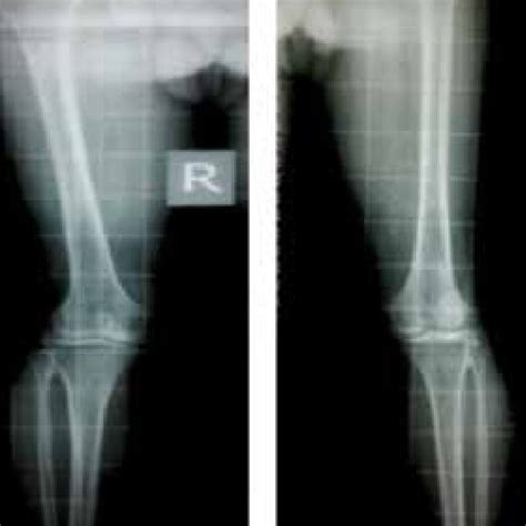 Long Leg Standing Radiography Of The Lower Extremity Download
