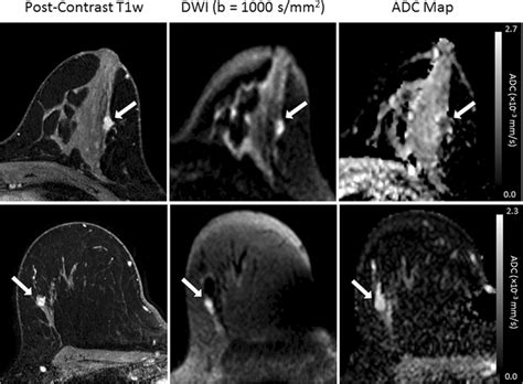 Diffusion Weighted Mri Dwi For Characterization Of Suspicious Lesions