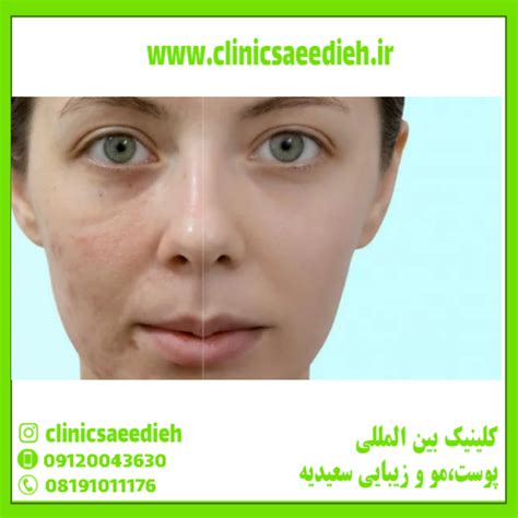 بهترین راهکارهای از بین بردن جای جوش و درمان آکنه کلینیک پوست و مو