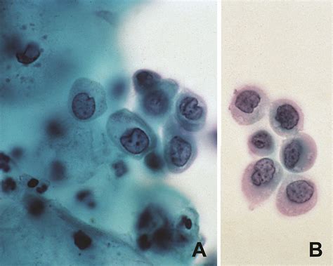 Fig 4 20 Atypical Squamous Cells Cannot Exclude A High Grade Squamous