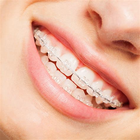 Clear Braces Braces For Adults San Antonio Tx Cochran Orthodontics