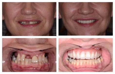 All On 4 Dental Implants Surrey Smile In A Day Procedure
