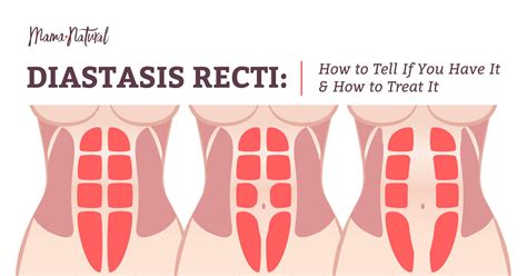 How To Know If You Have Diastasis Recti And What To D