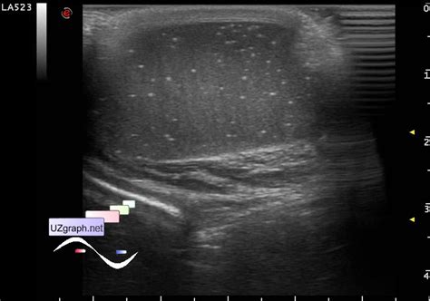 Testicular Microlithiasis Microcalcification Scrotum Sonography