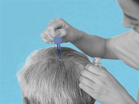 13 Best Hair Loss Treatments For Men 2023