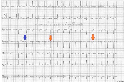 Ecg Rhythms Atrial Tachycardia With A Type I Block