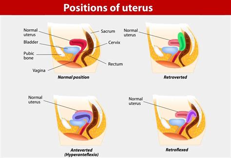 Anteverted Uterus Causes Symptoms Diagnosis And Treatment