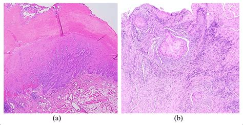 Photomicrograph Of Biopsy Specimen Revealed Severely Thickened Abnormal