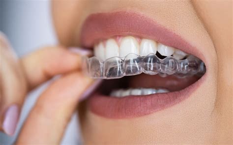 Your Guide To Dental Aligners Discreet Removable Solutions To