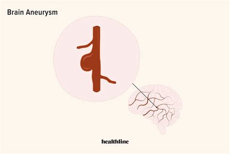 Brain Aneurysm Symptoms Causes Risk Factors